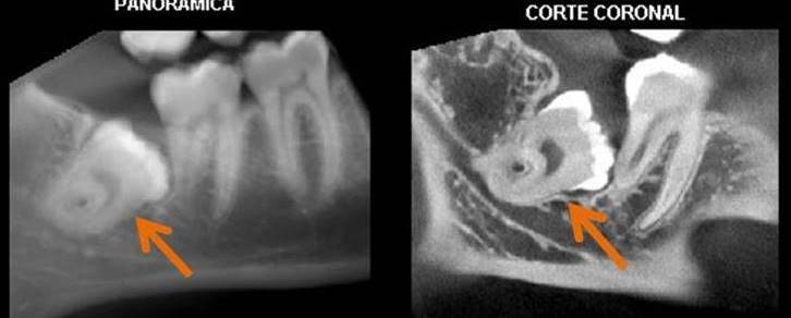 DENTES DO SISO – Alexandre Augusto Ferreira da Silva / cirurgia ...