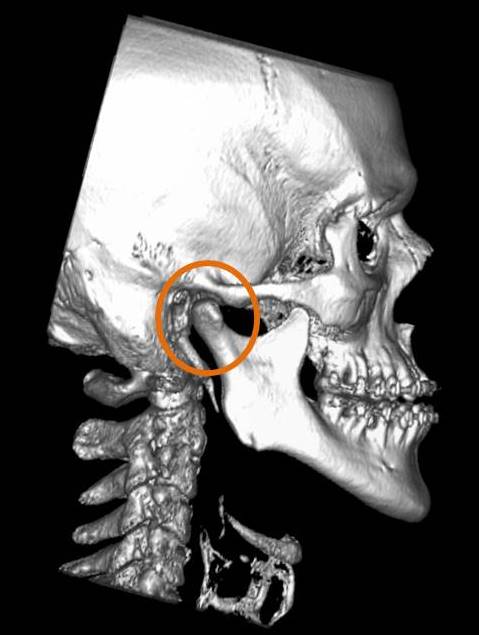 Luxacao Da Articulacao Temporomandibular