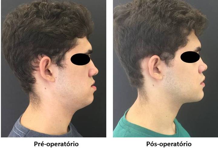 RELAÇÃO ENTRE O PESCOÇO E O MENTO (QUEIXO) NA HARMONIA FACIAL ...