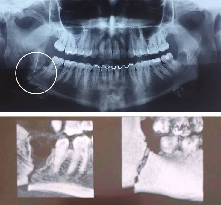 FRATURAS DE FACE – Alexandre Augusto Ferreira da Silva / cirurgia ...